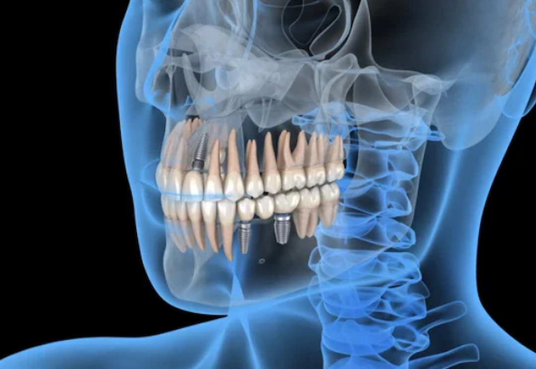 How Much Bone is Needed for a Dental Implant? - OC Dental Center