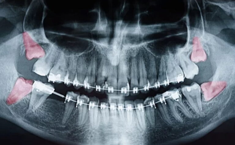 Average Number Of Teeth By Age - OC Dental Center