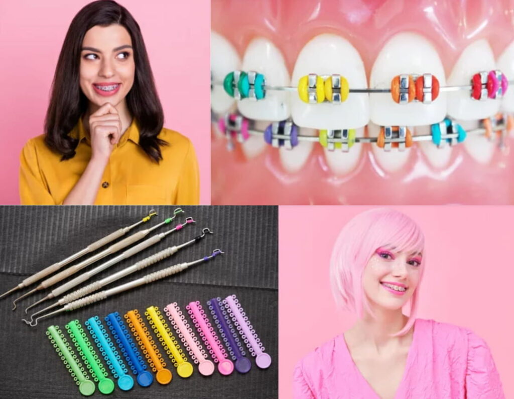 What Color Should I Get My Braces? - OC Dental Center