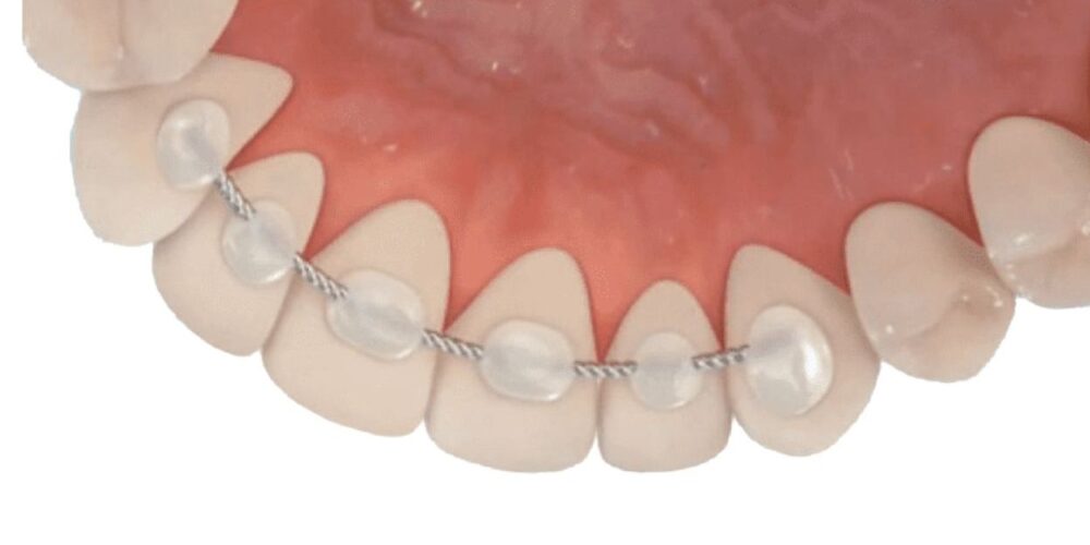 How Long Do You Have to Wear a Retainer? - OC Dental Center