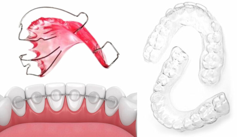 How Much Do Retainers Cost? - OC Dental Center